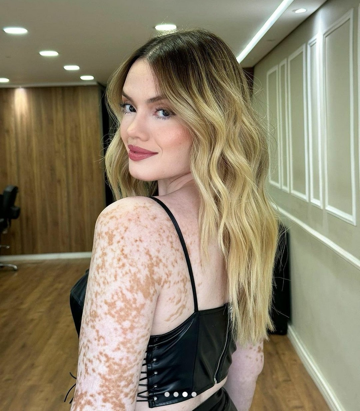 Vitiligo: influencer com a mesma doença de Michael Jackson, conta por ...