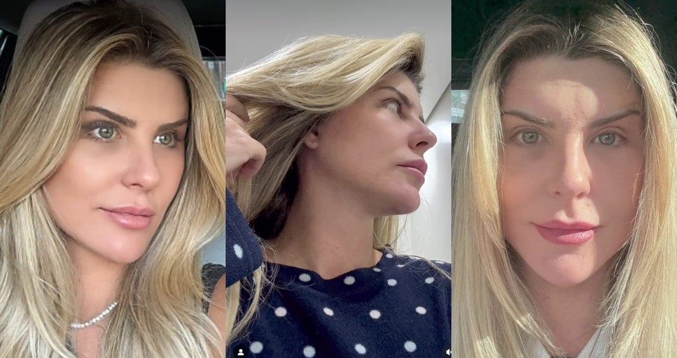 Íris Stefanelli exibe visual natural e rejuvenescido após procedimento; especialistas explicam ...