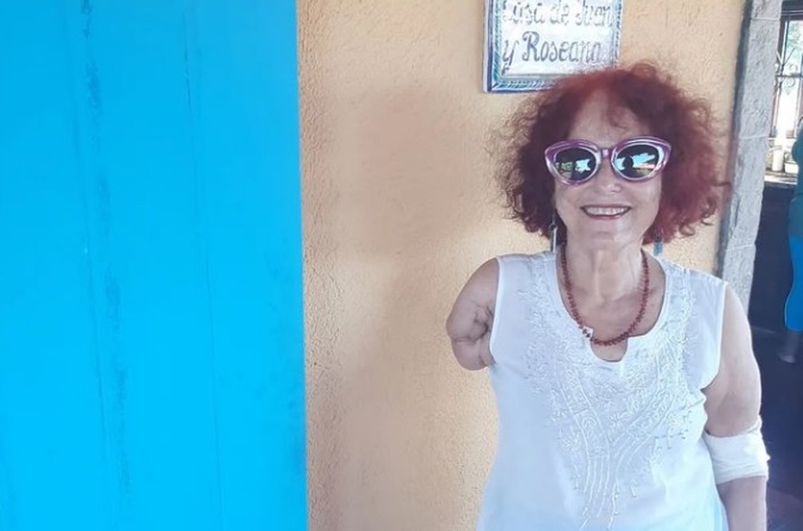 Amputada após ataque de pitbulls, Roseana Murray deve receber doação de ...