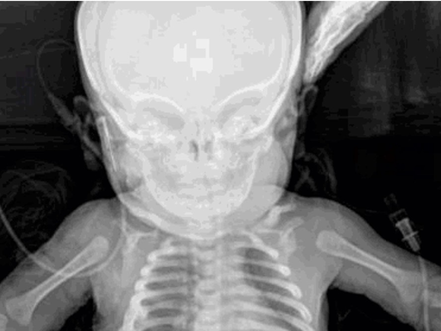 Radiografia De Tibia Fraturada