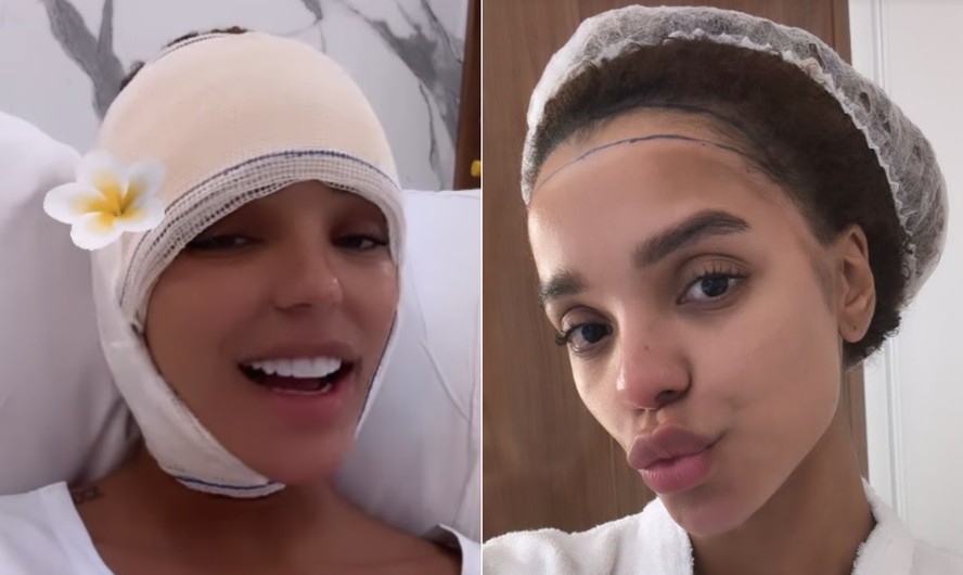 Entenda a frontoplastia, cirurgia que a ex-BBB Brunna Gonçalves fez ...