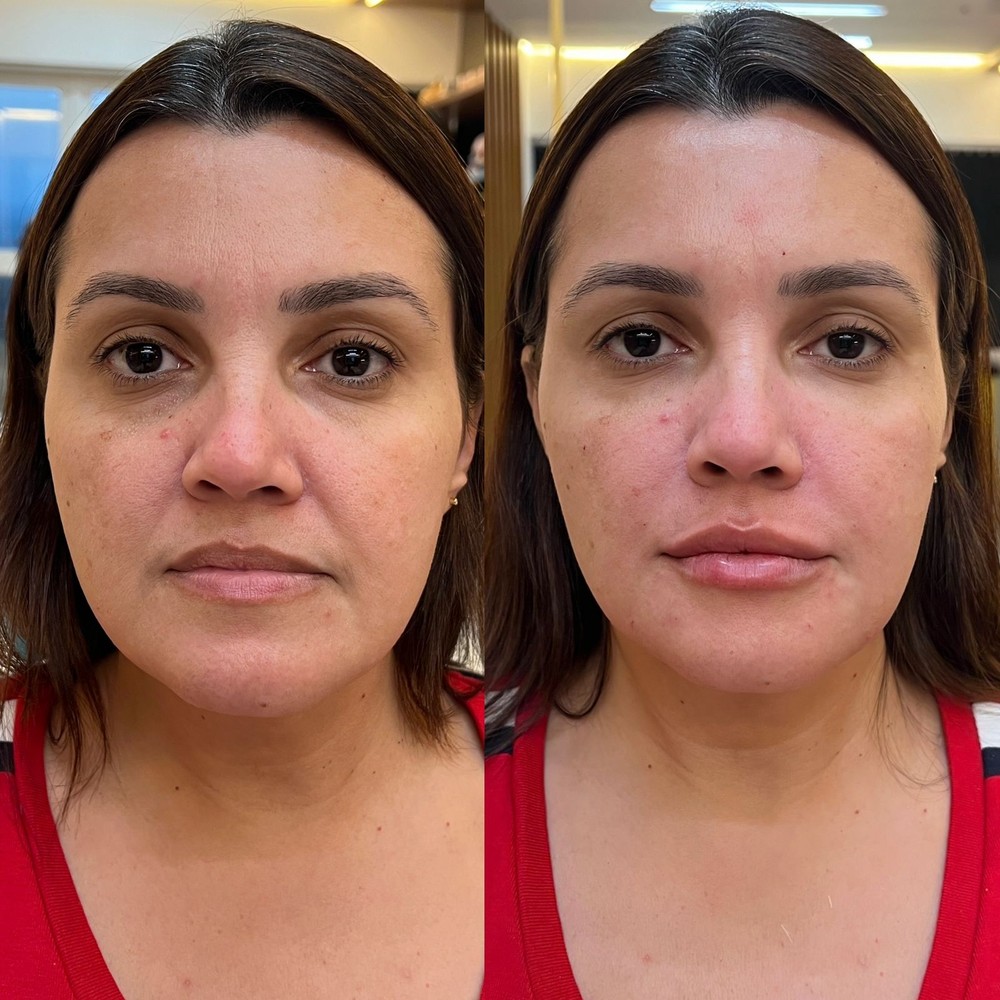 Bigode Chinês no rosto? Saiba como identificar + formas de tirá-lo