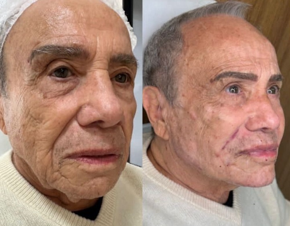 Stenio Garcia explica por que fez harmonização facial e rebate críticas ...