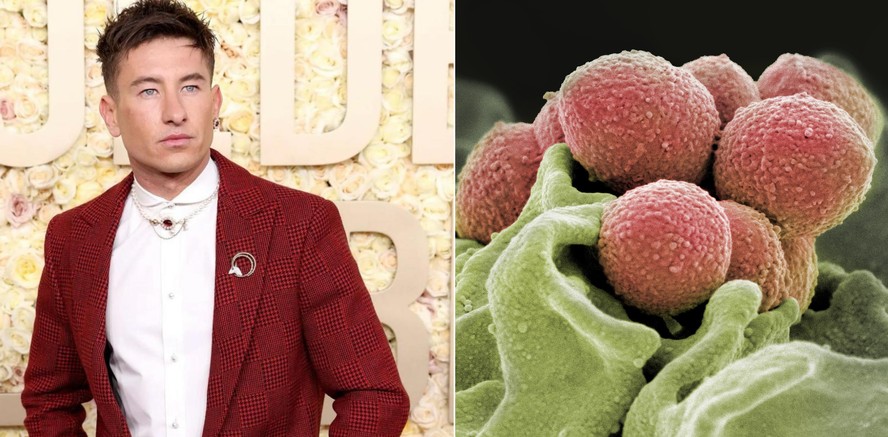 Fasciíte necrosante: o que é a doença causada por uma bactéria ...