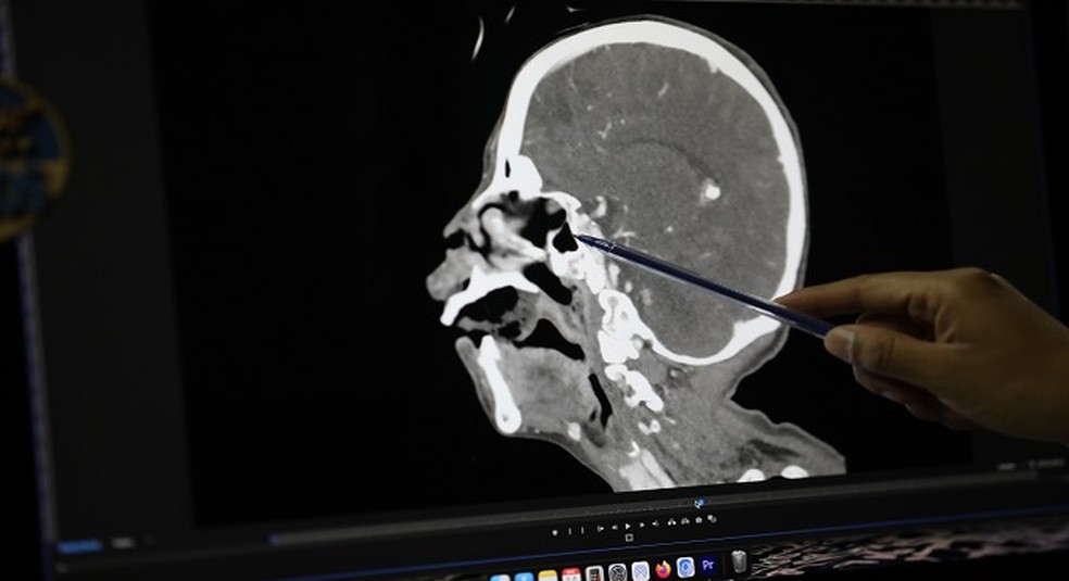 Miíase oral: Médicos encontram 150 larvas alojadas na boca de uma ...