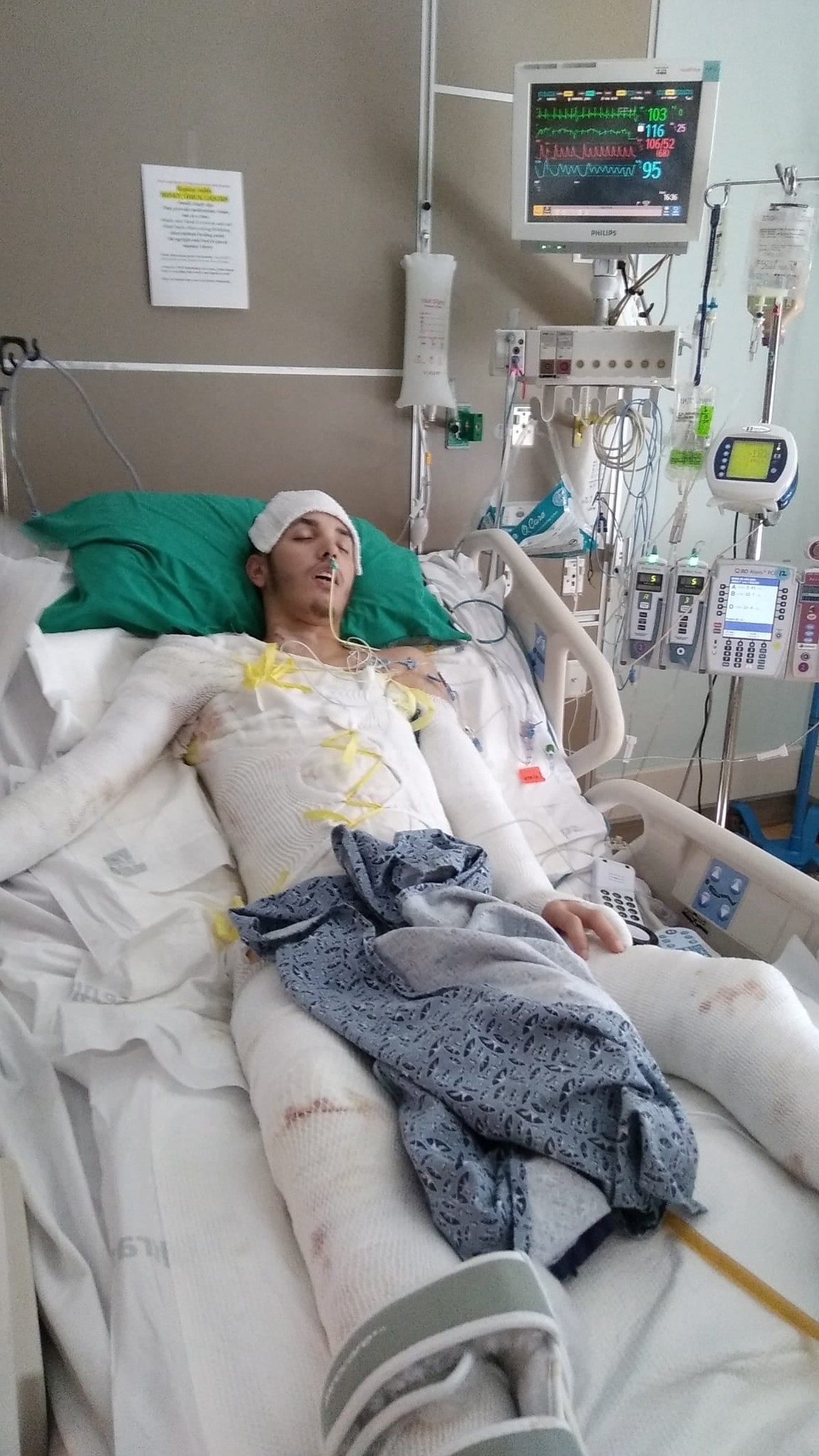 Homem tem 75% do corpo queimado após arma de choque atingir bomba de ...