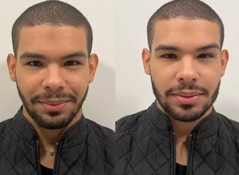 Harmonização facial: veja o antes e depois dos BBBs que fizeram o ...