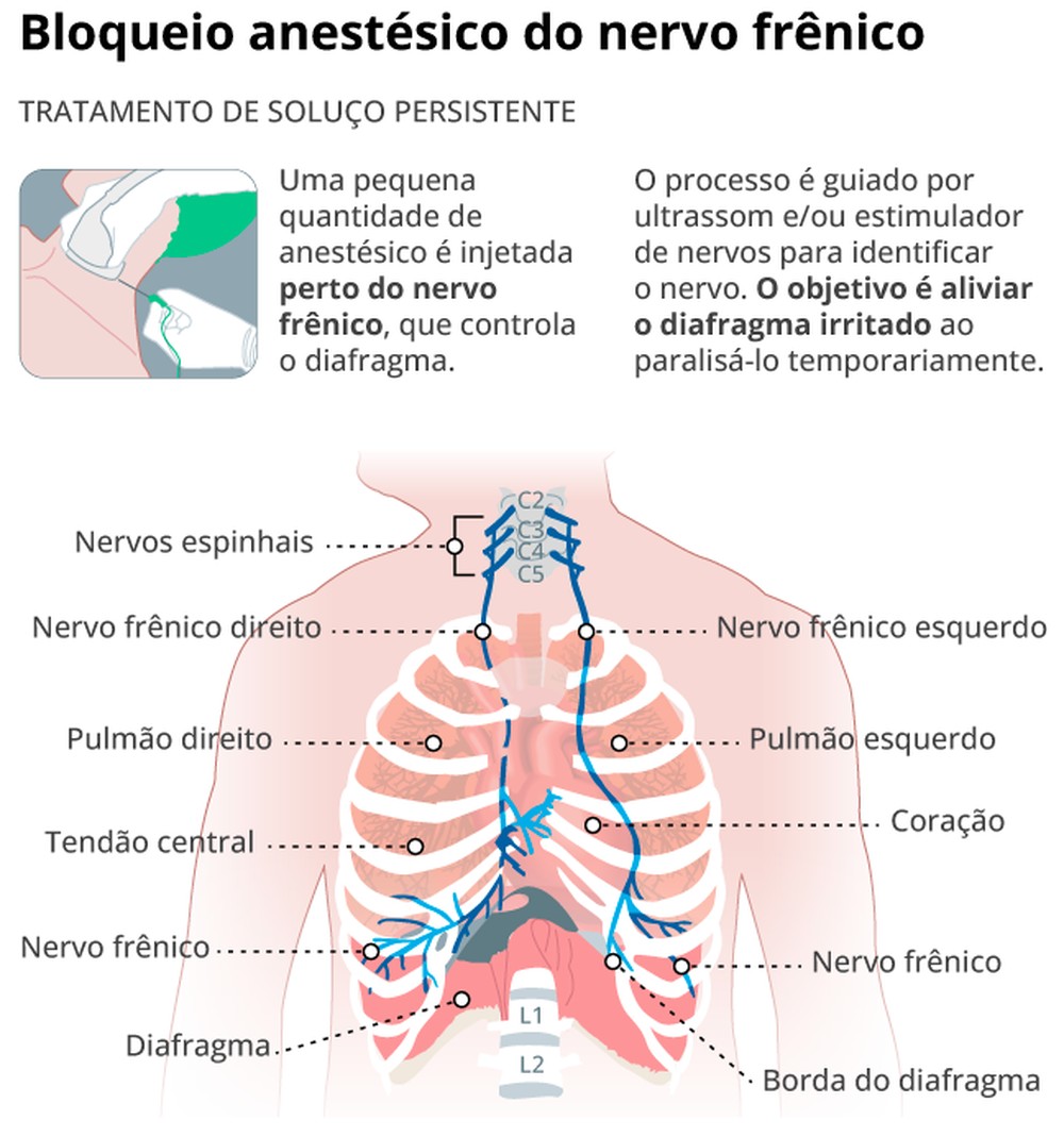 Entenda o que é bloqueio anestésico do nervo frênico, procedimento ao ...
