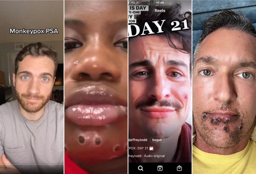Varíola dos Macacos: pacientes publicam relatos e mostram lesões em ...