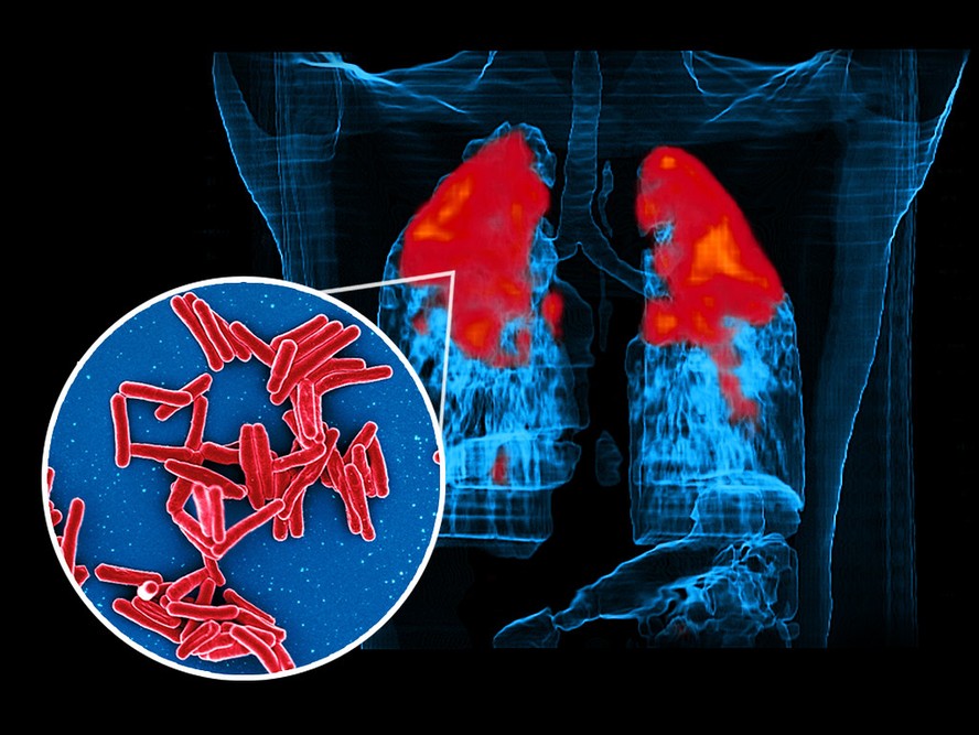 Tuberculose Pulmoes Humanos SESA Dia Mundial De Combate à