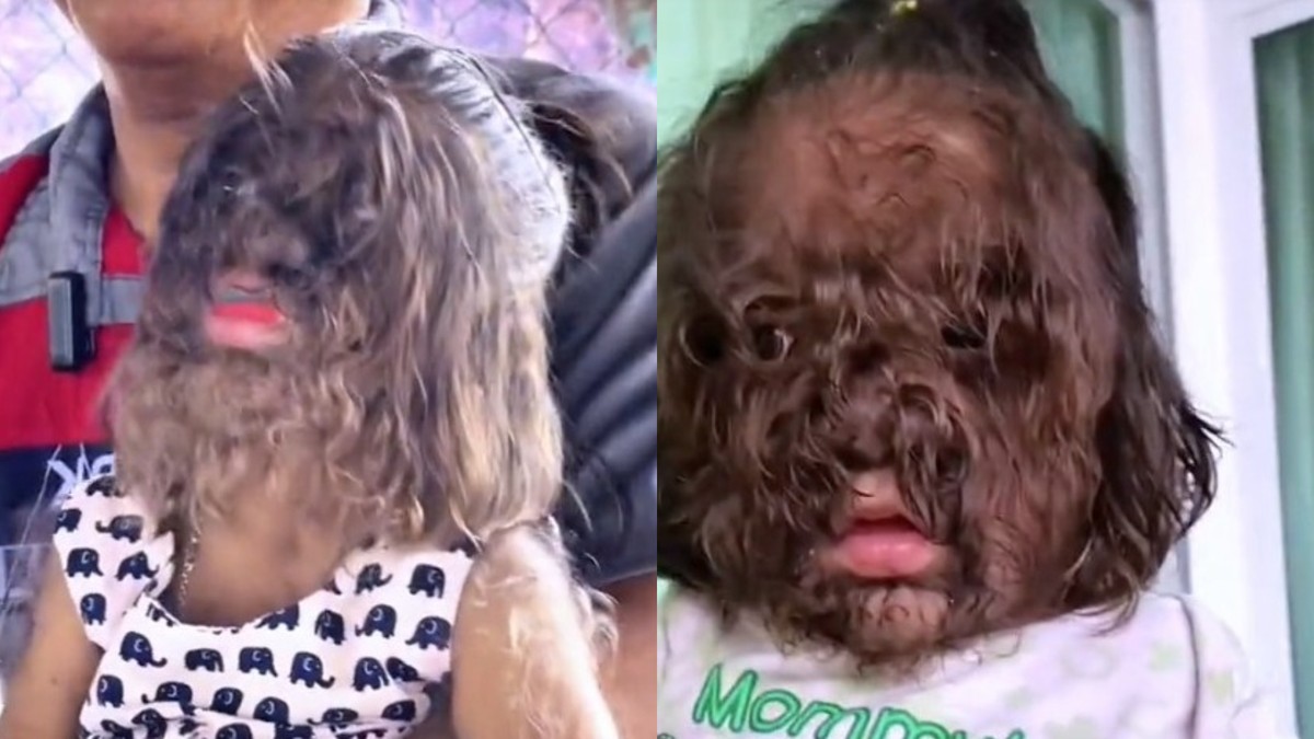 'Síndrome do Lobisomem': vídeo de menina de dois anos viraliza por ...