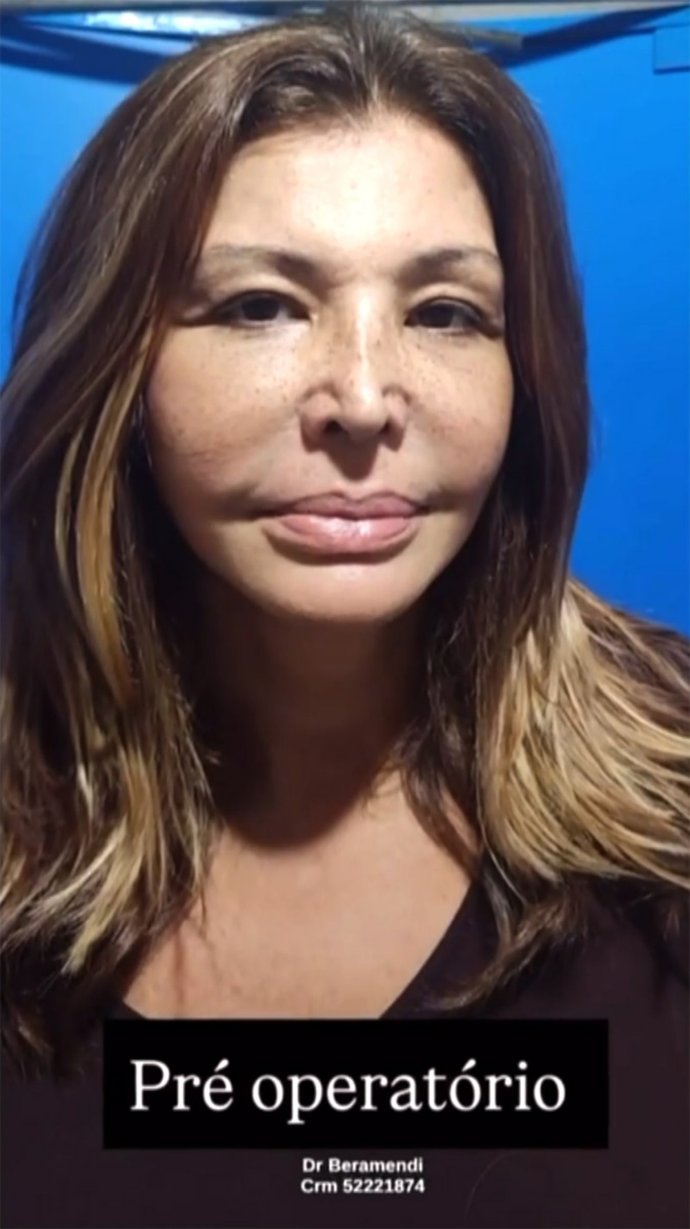 Roberta Close: entenda a técnica realizada pela ex-modelo que ...