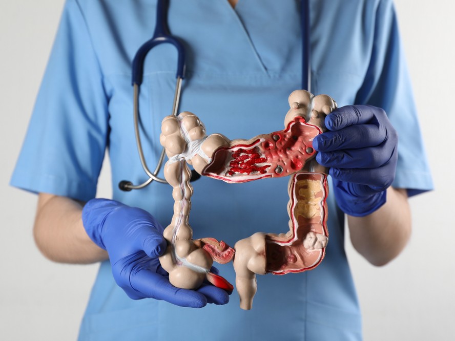 Câncer De Intestino Em Jovens Preocupação De Oncologistas