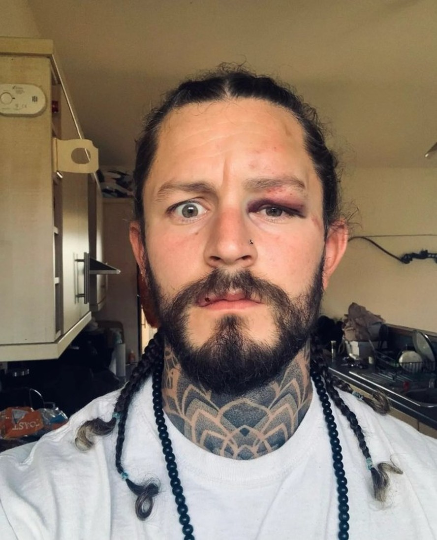 'Clube da Luta': Homem tem orelha arrancada por mordida na Inglaterra