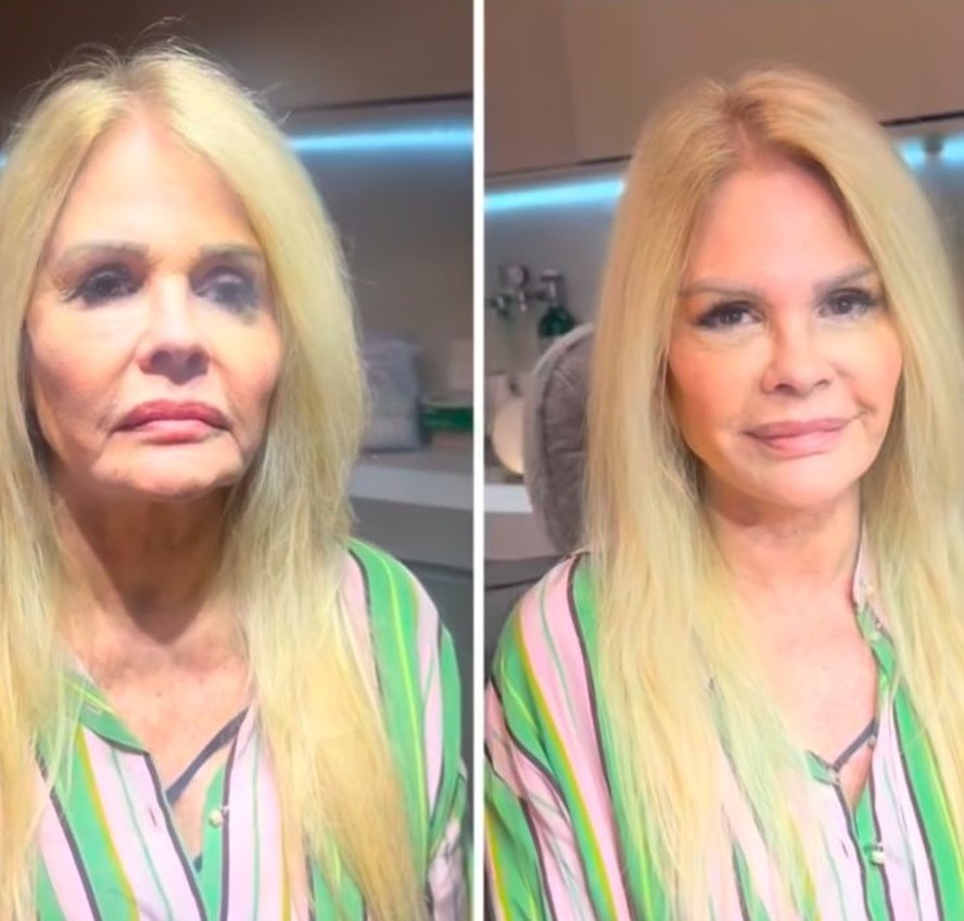 Monique Evans mostra antes e depois de procedimento estético no rosto