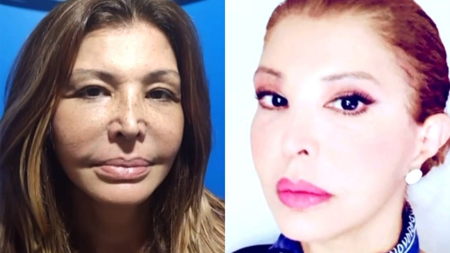 Roberta Close: entenda a técnica realizada pela ex-modelo que rejuvenesce sem perder naturalidade