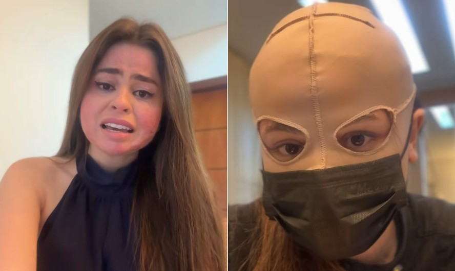 Peeling de ATA com óleo de Cróton: entenda o que é o procedimento ...