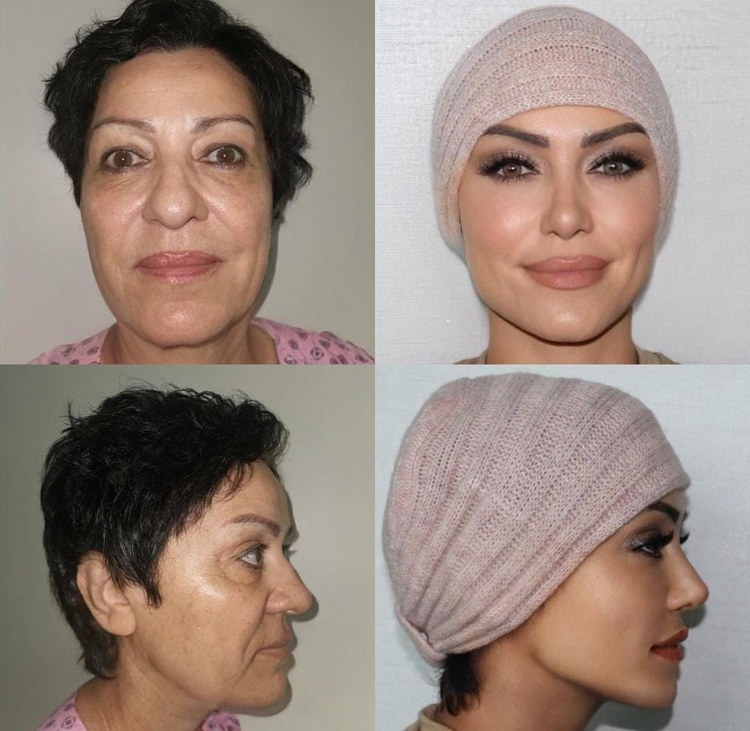 Resultado De Procedimento Estético Viraliza Por Antes E Depois Na