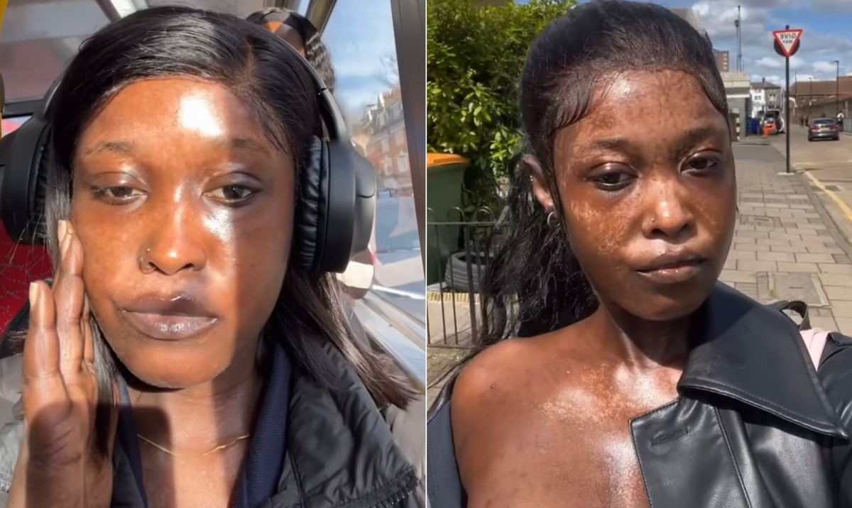 Influencer com vitiligo mostra o passo-a-passo do desenvolvimento da ...