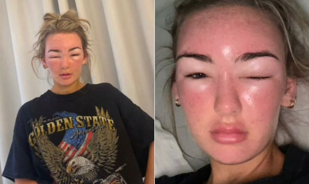 Mulher desenvolve inchaço 'extremo' no rosto após sofrer insolação ...