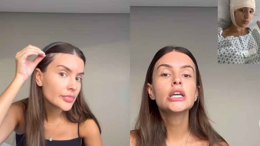 Ex-BBB Thais Braz detalha cirurgia para redução da testa e mostra ...