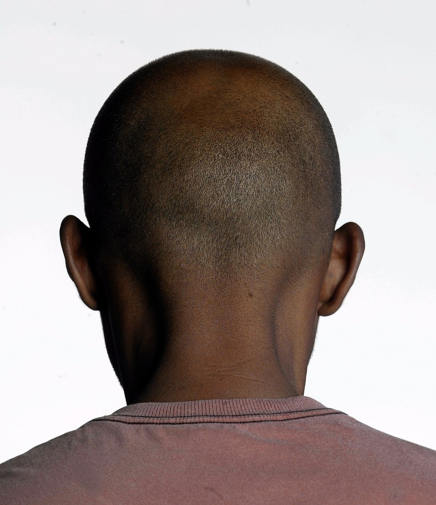 Calvice: transplantes e implantes capilares crescem 60% no Brasil