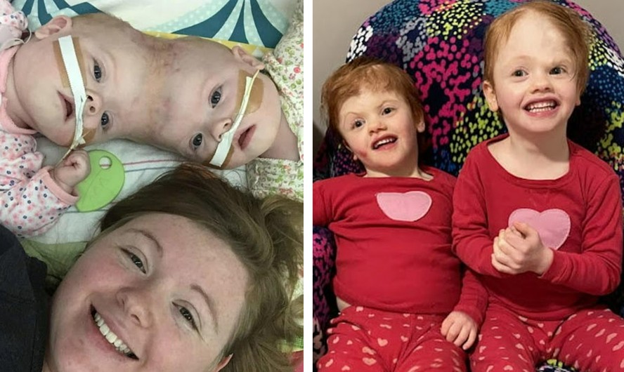 Tipos De Gemeos Siameses Gêmeos Siameses: Por Que Duas Pessoas Nascem