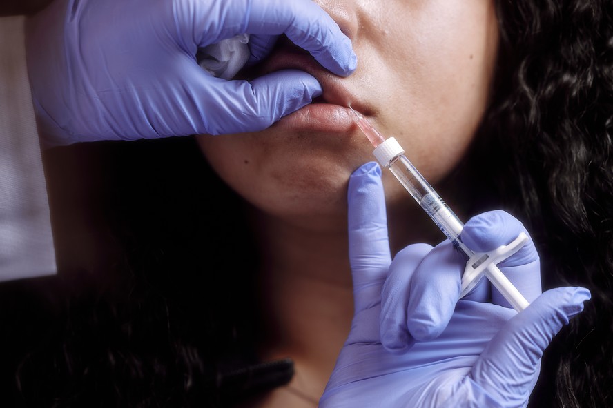 Pensa Em Fazer Preenchimento Labial Veja As 4 Coisas Que Você Precisa