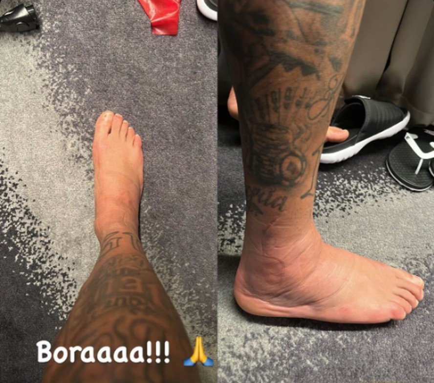 Ainda com o tornozelo inchado, Neymar posta foto do pé após lesão