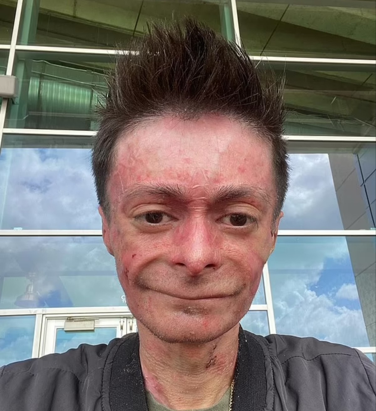 Homem de 28 anos vive com doença rara que faz a pele ficar frágil a ...