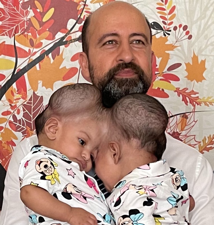 Unidas pela cabeça: gêmeas siamesas são separadas após 14 horas de ...