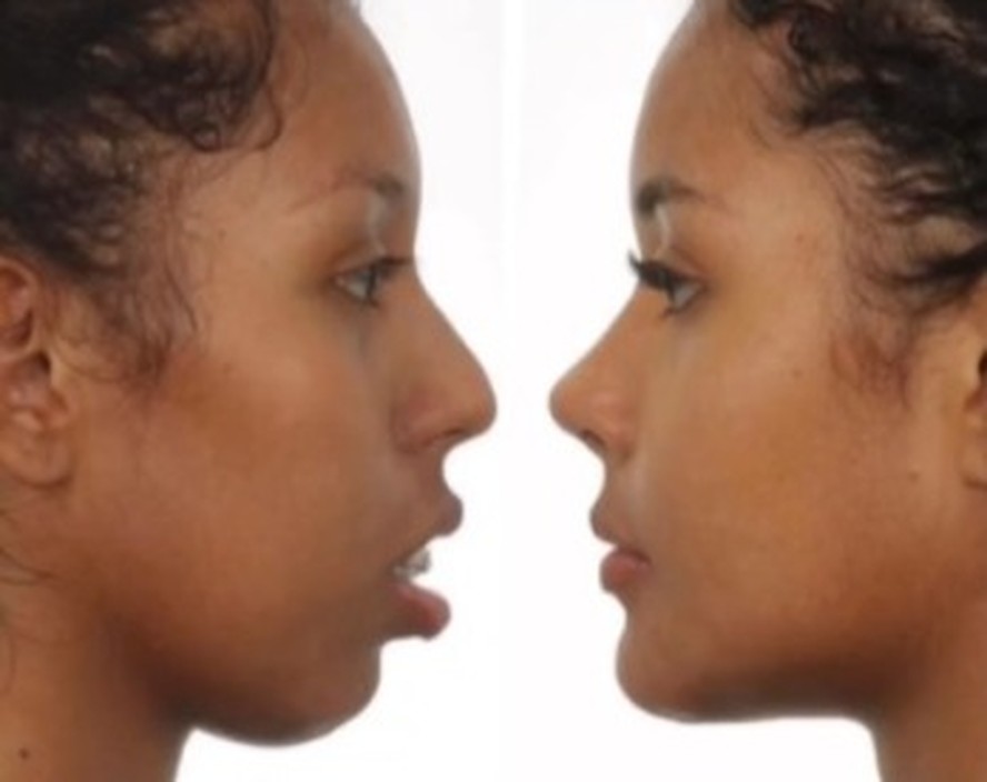 'BBB 25': O que é cirurgia ortognática, procedimento feito no rosto de Giovanna, irmã de ...