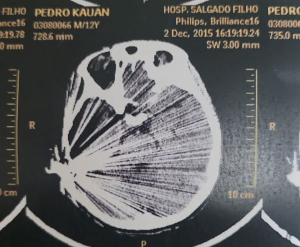 G20 Social: jovem que sobreviveu a tiro de fuzil na cabeça, sequestro e ...