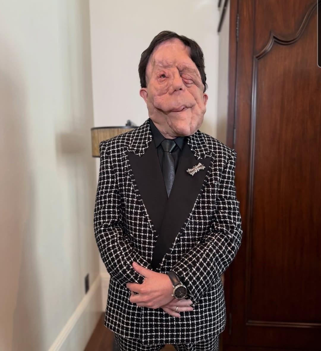 Quem é Adam Pearson, ator com neurofibromatose que foi ao Oscar e ...
