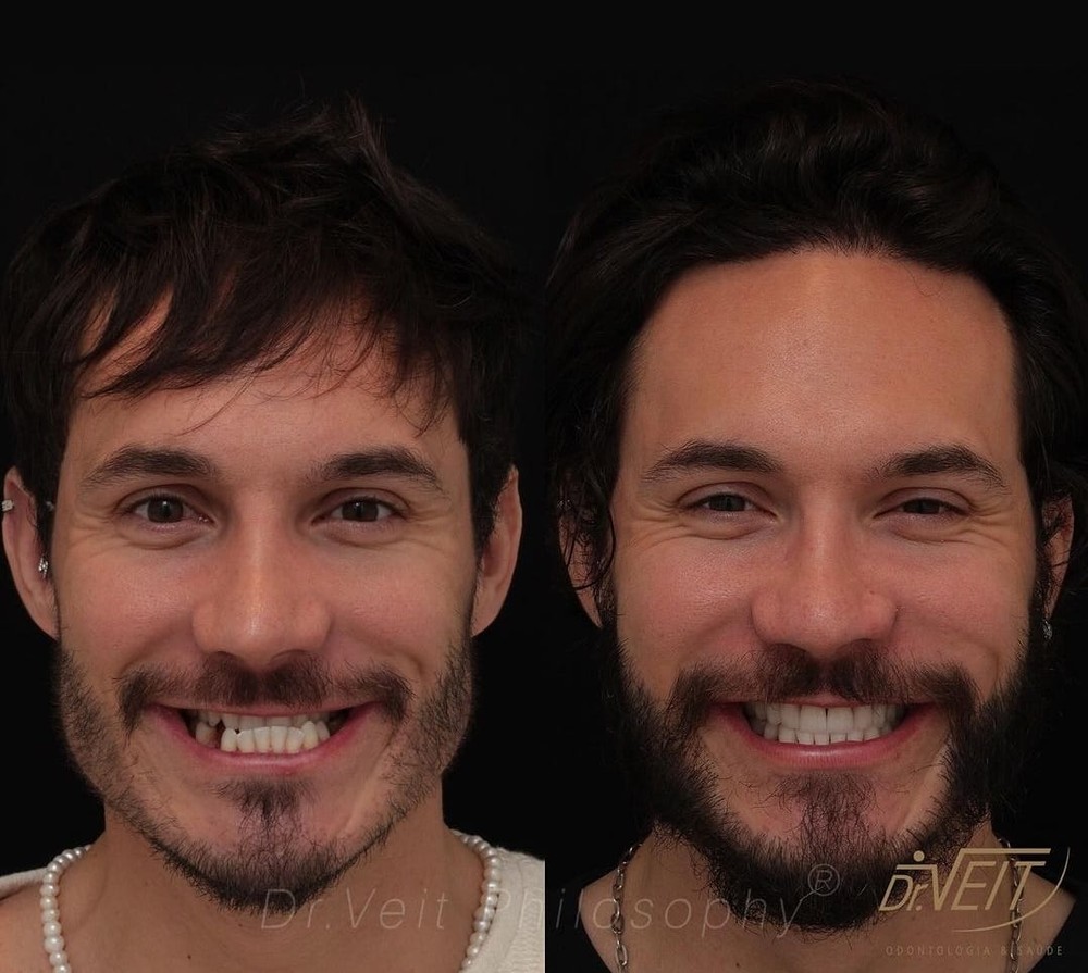 Implante capilar, preenchimento maxilar e mais: veja procedimentos já ...