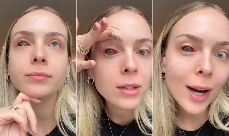 Tata Estaniecki fala sobre rompimento de vaso no olho; entenda o que é o hiposfagma e se há riscos