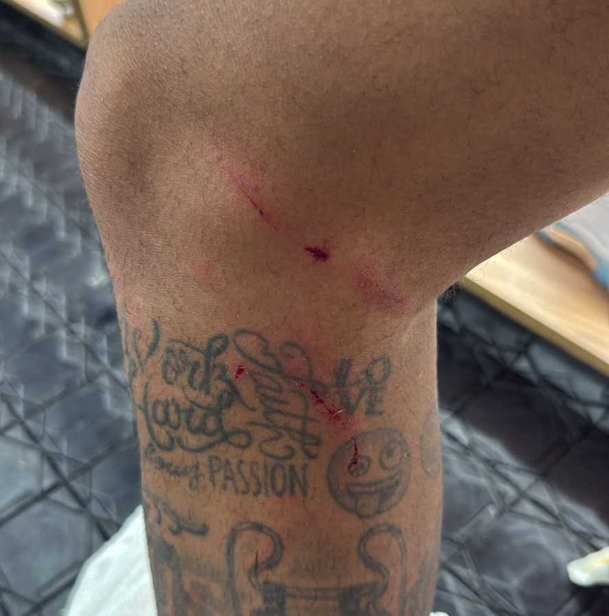 Neymar mostra perna machucada após Santos x Fluminense: 'Sem intenção ...