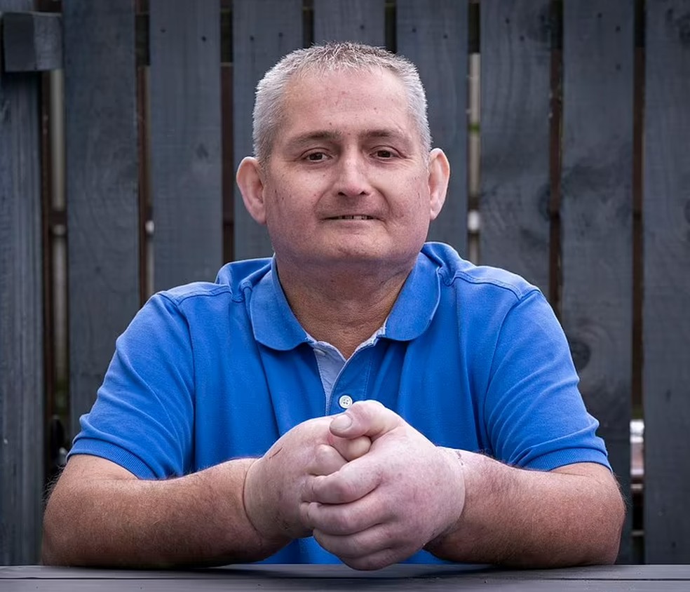 Britânico recebe primeiro transplante duplo de mãos para tratar ...