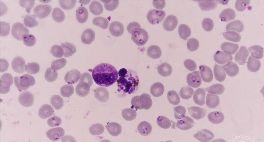 Malária: cientistas de 21 países encontram 1º caso no mundo e descobrem ...