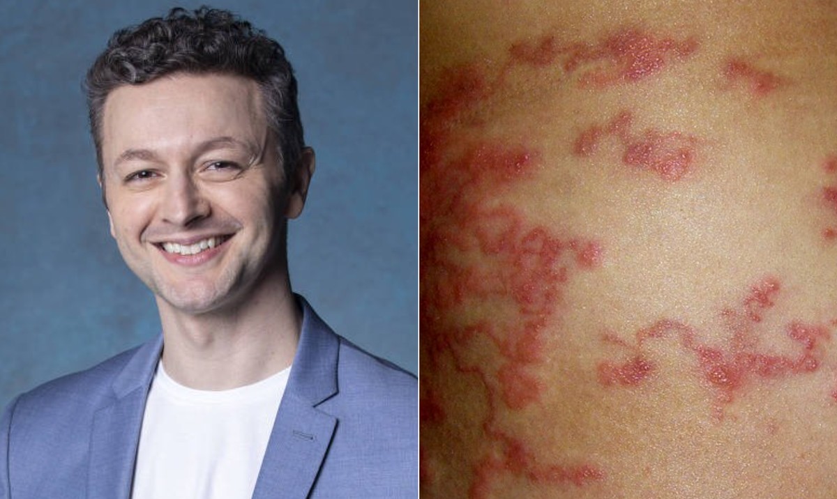 Entenda os sintomas e o tratamento de bicho geográfico; doença que ...