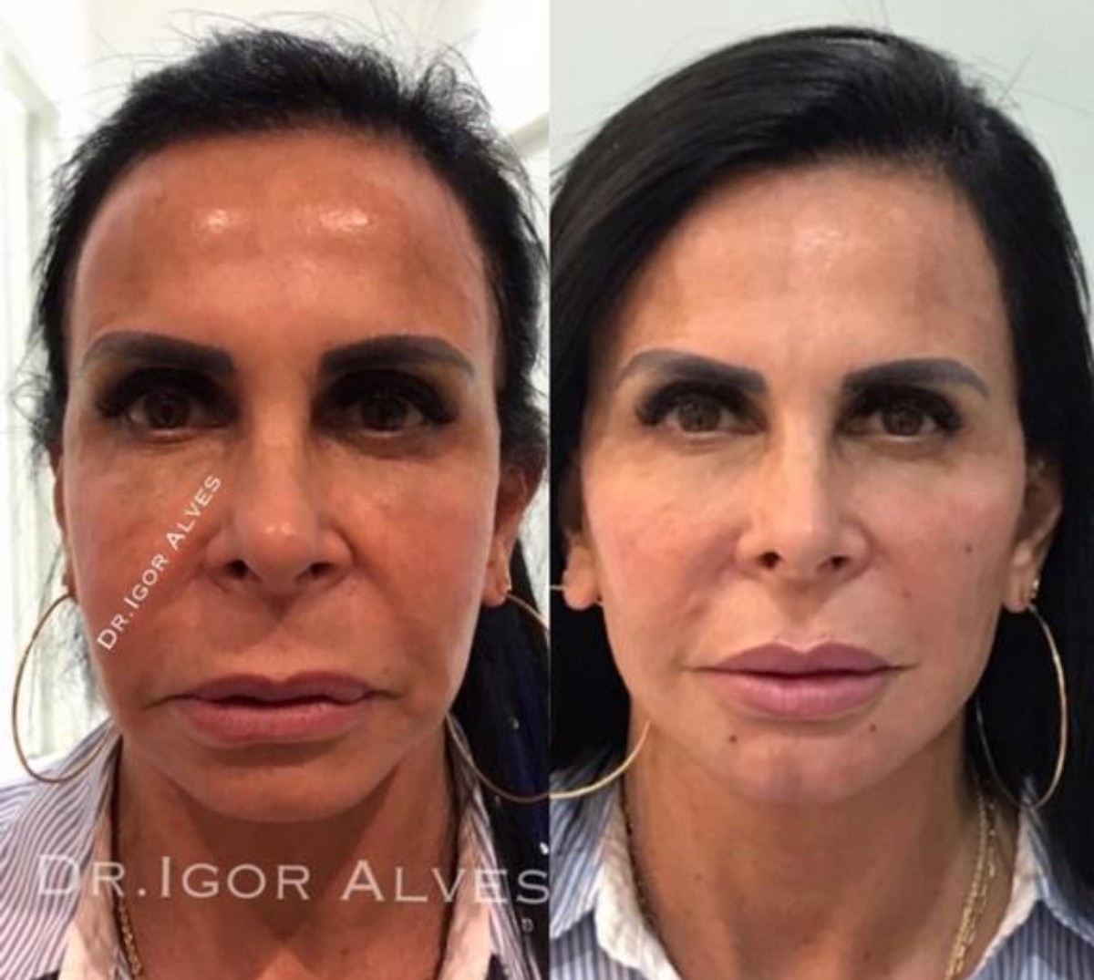 Mais de 45 anos depois: após sucesso espontâneo, Gretchen anuncia que ...