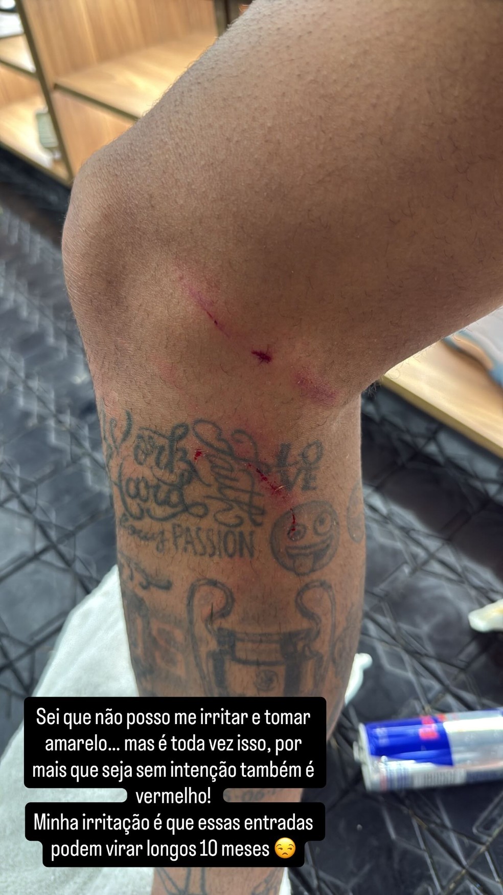 Neymar mostra perna machucada após Santos x Fluminense: 'Sem intenção ...