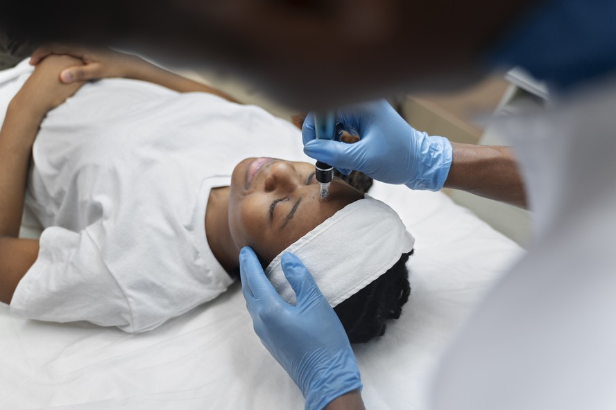 Acne: o microagulhamento é o tratamento mais eficaz para as cicatrizes ...