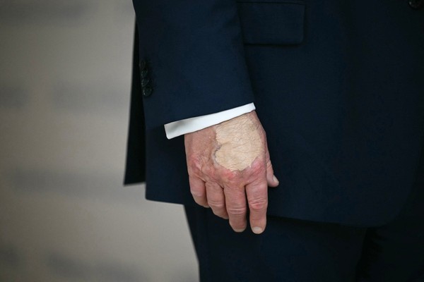 Trump reaparece com mão maquiada após diagnóstico de insuficiência ...