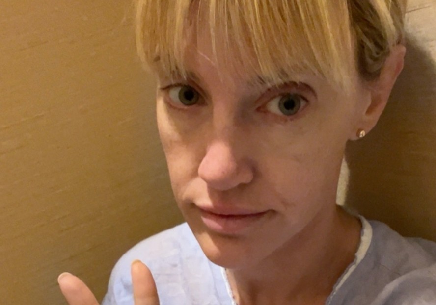 Americana tem nariz 'destruído' após rinoplastia de 10 mil dólares: 'Fico triste quando olho no ...